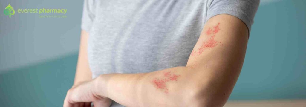 NHS Shingles Treatment in Manchester - Everest Pharmacy
