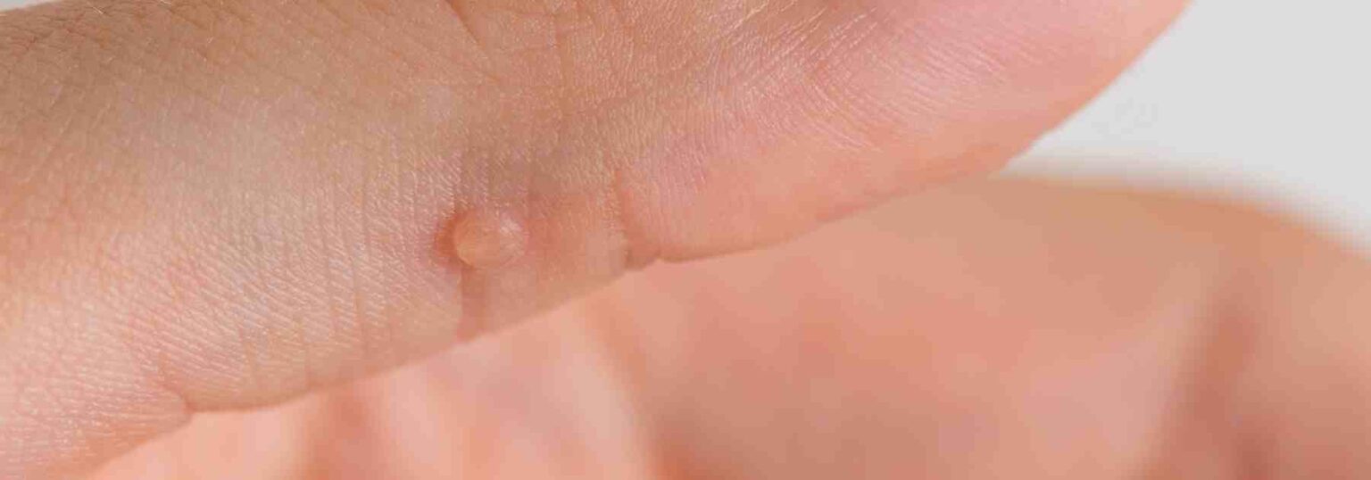 Wart Freeze: How Cryotherapy Works - Everest Pharmacy