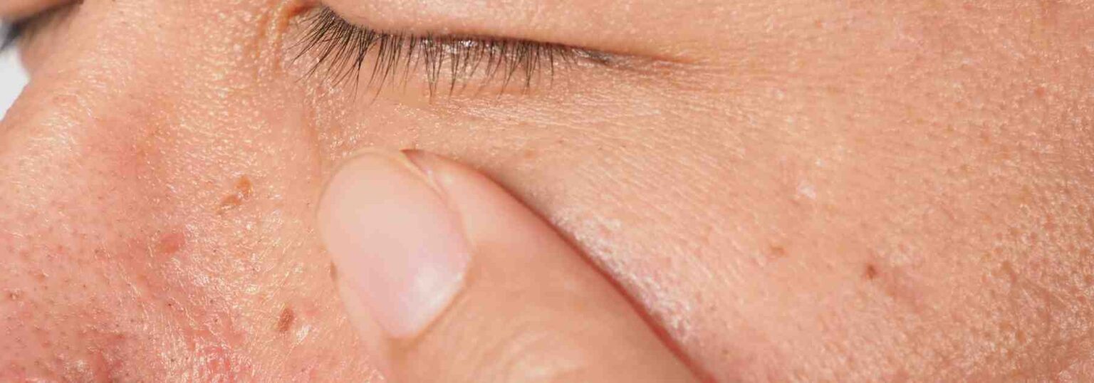 How Can You Remove a Skin Tag at Home? Debunk the Myths - Everest Pharmacy